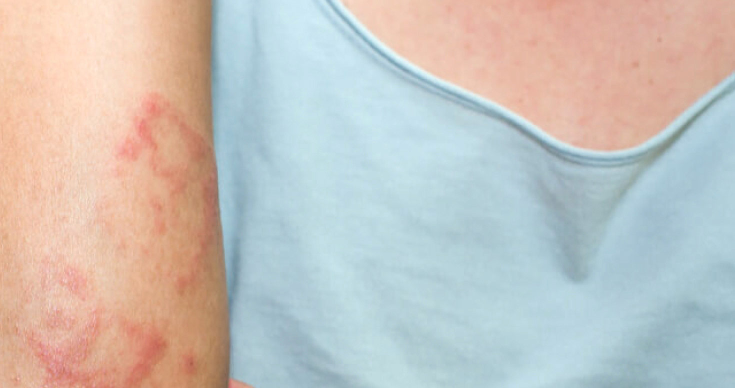 تغيرات جلدية تنذر بوجود داء السكري - SO7TAK